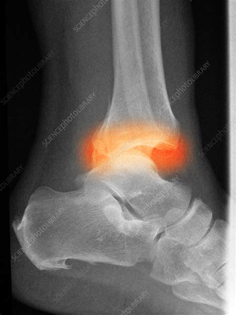 Fracture And Dislocation Of The Ankle Stock Image C009 4735 Science Photo Library