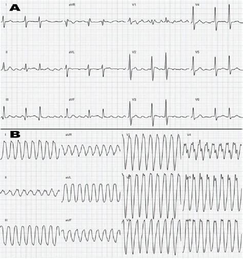 Figue 1 A Basal Ecg With Atrial Flutter And Unspecific Download