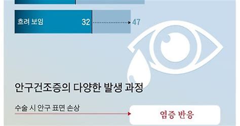 눈에 모래 낀듯 이물감백내장 수술 뒤 안구건조증 빈발