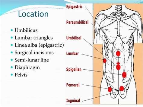 Types Of Hernia Classification Of Hernias Based On Lo