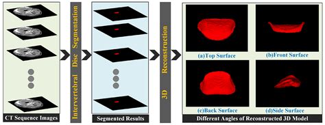 Cervical Intervertebral Disc Segmentation Based On Multi Scale