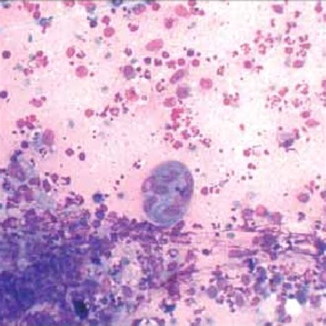 Ill Formed Epithelioid Cell Granulomas Langhans Giant Cells And