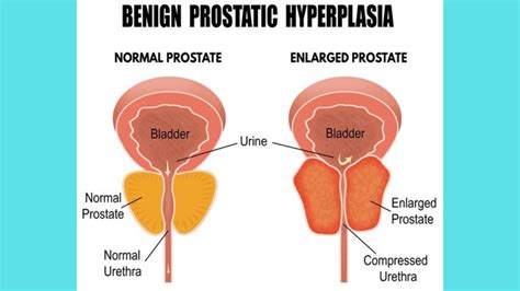 Benign Prostatic Hyperplasia Top Pharmaceutical Wholesaler Exporter