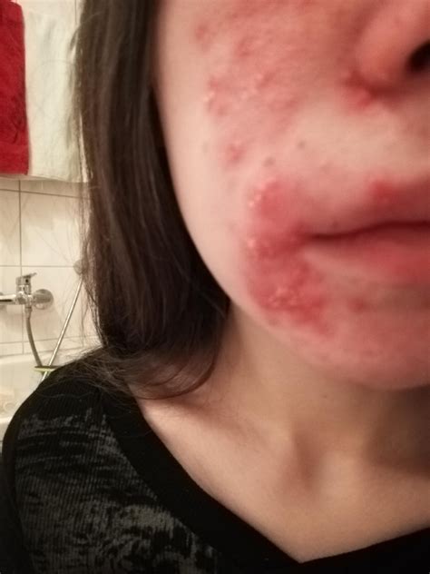 Before And After Doxycycline Treatment R Acne