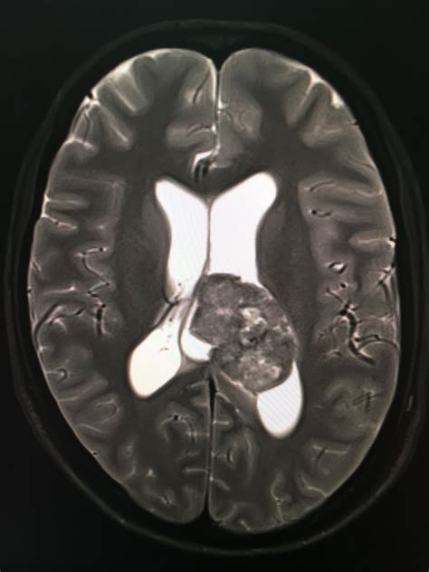 Dural Arteriovenous Fistula Artofit
