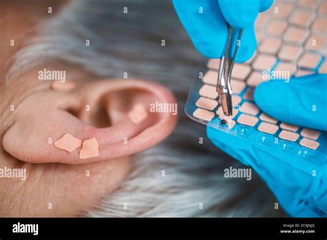 Auriculotherapy Or Auricular Treatment On Human Ear Close Up