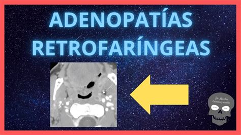 AdenopatÍas Retrofaringeas👉truco Para Encontrarlas En Las Imágenes Youtube AdenopatÍas Retrofaringeas👉truco Para Encontrarlas En Las Imágenes Youtube