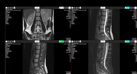 Mri Of Lumbar Spine Rsciatica
