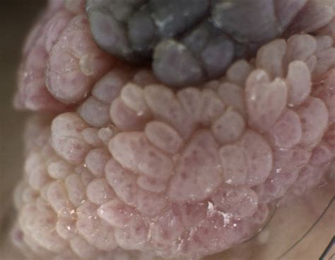 남자 곤지름 치료 중 관계해도 될까요 네이버 블로그