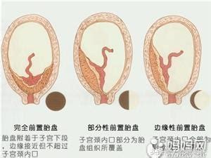 胎盤低置前置胎盤可以順產嗎 每日頭條