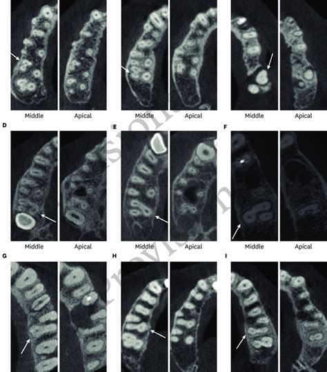 Maxillary First And Second Molars Fused Root Type 1 2 And 3 A C Download Scientific