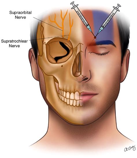 Supraorbital Nerve Origin