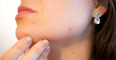 11 Rimedi Naturali Anti Acne Ambiente Bio