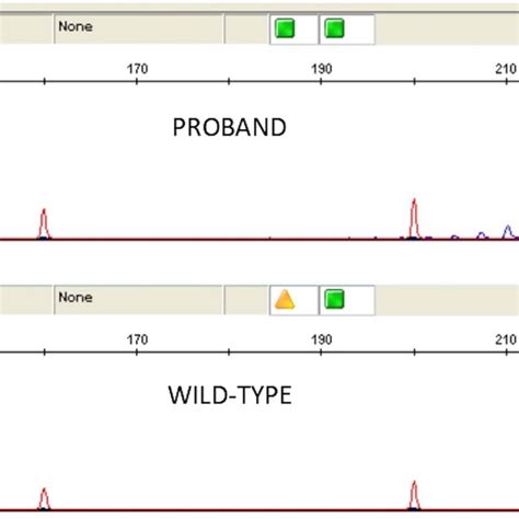 Molecular Analysis Of Jph3 Showing Heterozygous Expansion Of More Than