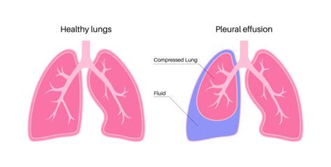 Empyema Vs Pleural Effusion Whats The Difference