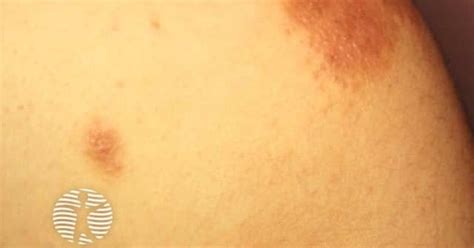 Nummular Dermatitis Discoid Eczema Image