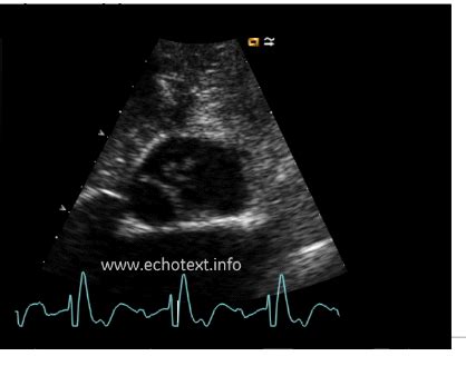 Echo Images Flashcards Quizlet
