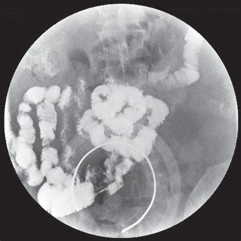 Pdf Blue Rubber Bleb Nevus Syndrome Case Report