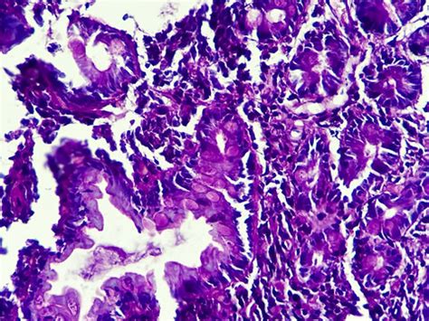 รปภาพLiposarcoma เลอกดภาพถายสตอก เวกเตอร และวดโอ Adobe Stock