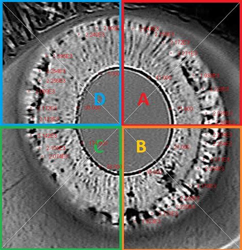 Iris Transillumination Defects