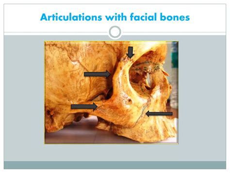 Zygomatic Complex Fracture Zmc Ppt