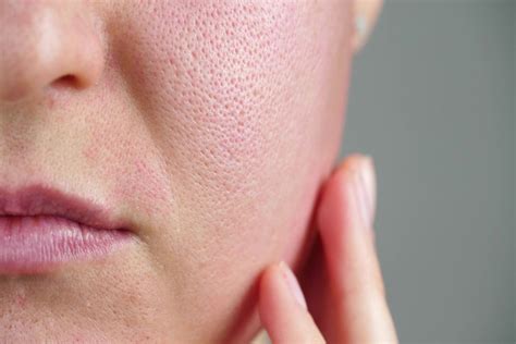 Piel seca con acné cómo tratarla y qué productos usar Tua Saúde