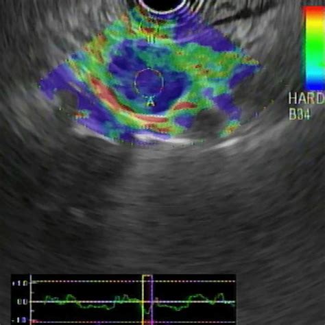 Contrast Enhanced Eus In Patient With Pdac Hypo Enhanced Appearance Of Download Scientific
