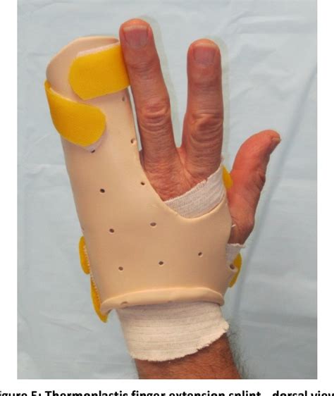 Hand Splint For Dupuytrens Contracture Online Stores