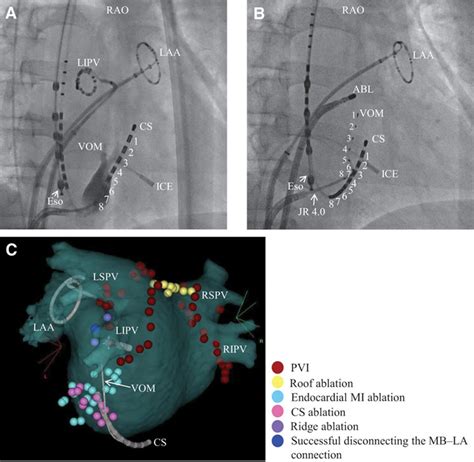 Mitral Isthmus Ablation Circulation Arrhythmia And Electrophysiology