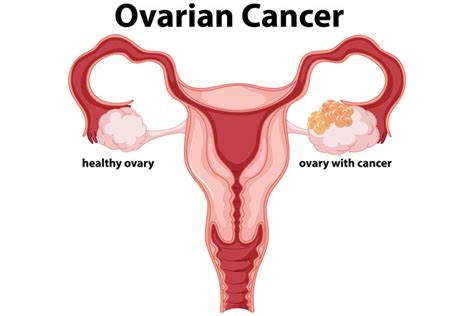 모성간호 난소암ovarian Cancer 문헌고찰