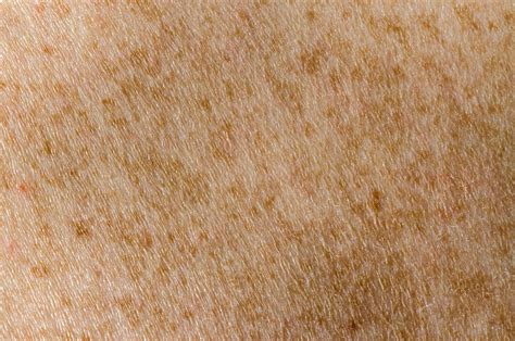 Pigmented Lesions Skintex