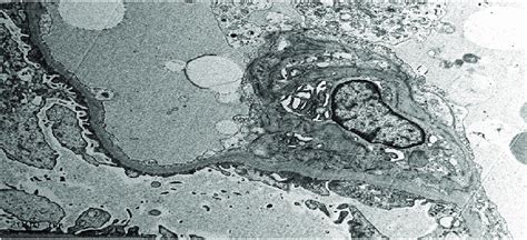 Electron Microscopy Of Renal Biopsy Download Scientific Diagram