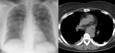 Primary Peritoneal Cancer Survival Rate Stage 4
