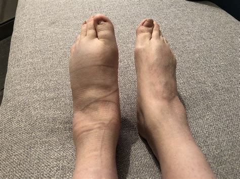 Swelling Or Edema Of The Tissues Particularly In The Legs Is A Common