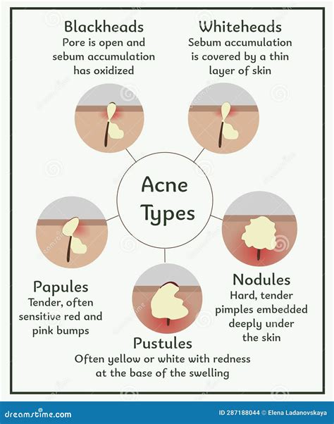 Tipos De Acne Ilustração Médica Infografia Sobre Pele E Dermatologia