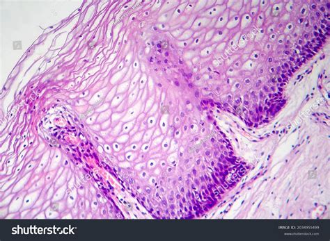 Cancer Cervix Light Micrograph Photo Under Stock Photo Shutterstock
