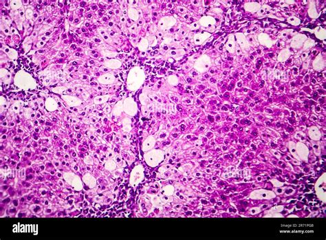 Histopathology Of Acute Hepatitis Light Micrograph Photo Under