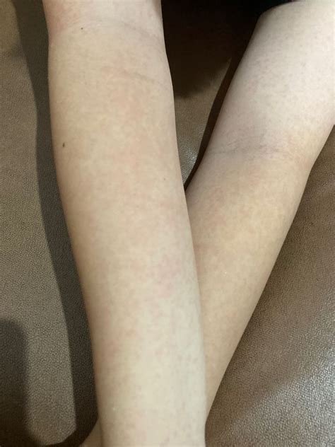 發問 皮膚紅紅的 問答板 Dcard