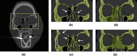 comparisons of various segmentations in two dimensional slice images