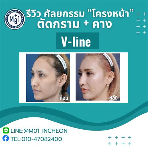 👆🏻อยากผ่าต คลีนิกความงาม อินชอน ร้อยไหม ฟิลเลอร์ โบท้อกซ์