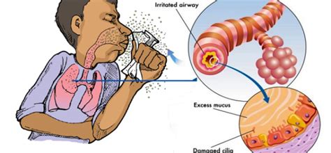 Chronic Cough Symptoms And Causes