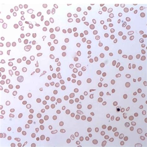 Sex Distribution Of G6pd Deficiency Among Subjects Abbreviation G6pd