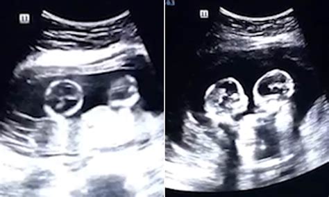 Identical Twins In The Womb Hiccups Pregnancy