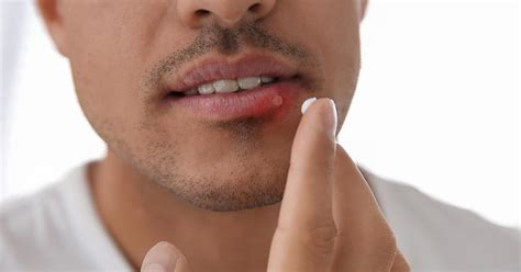 Angular Cheilitis Vs Cold Sore Home Remedies For Angular Cheilitis