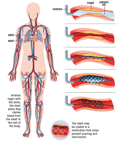 Aortic Artery Blockage