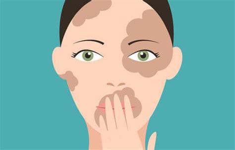 关于白癜风的那些事儿 知乎