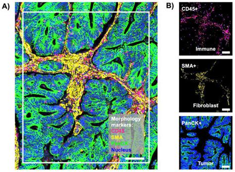 Spatial Transcriptomic Profiling Of Tetraspanins In Stage 4 Colon