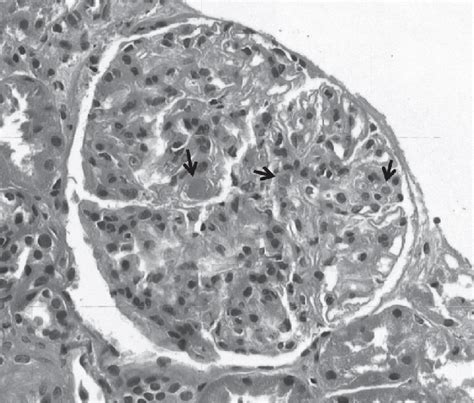 The Glomerulus Displays A Moderate Mesangial Hypercellularity And