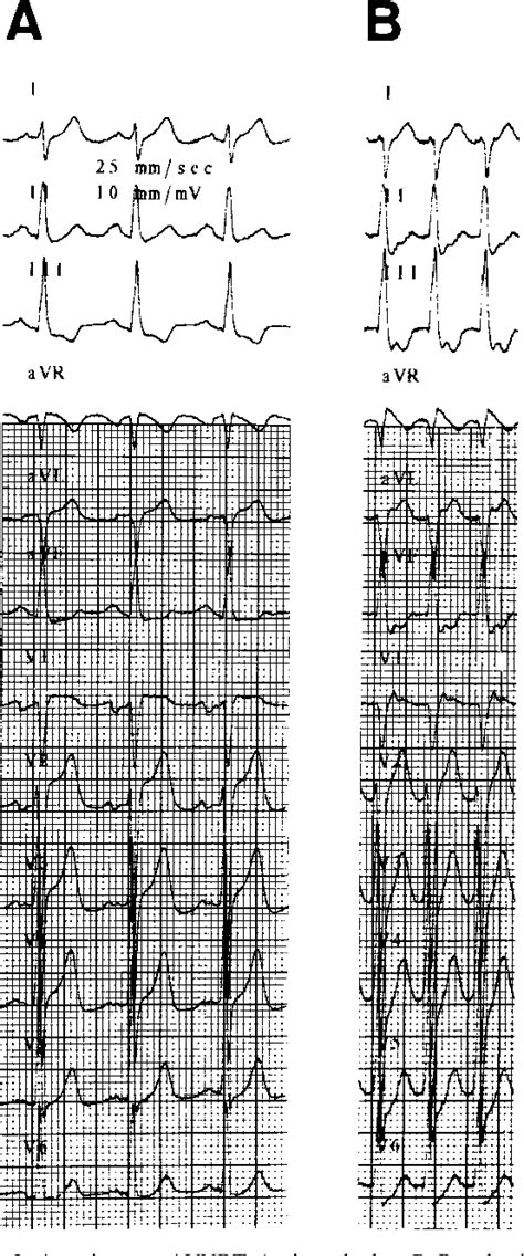 Figure 1 From A New Electrocardiographic Algorithm Using Retrograde P