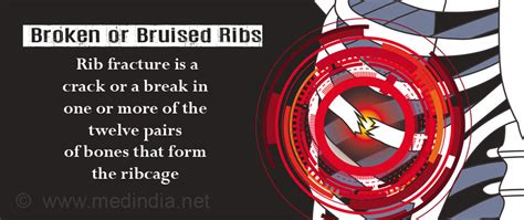 Broken Or Bruised Ribs Types Causes Symptoms Risks Complications